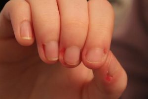Skin Picking Disorder Symptoms - Treatment for Skin Picking Disorder